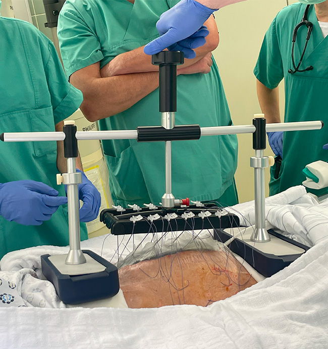 Close open abdomen early