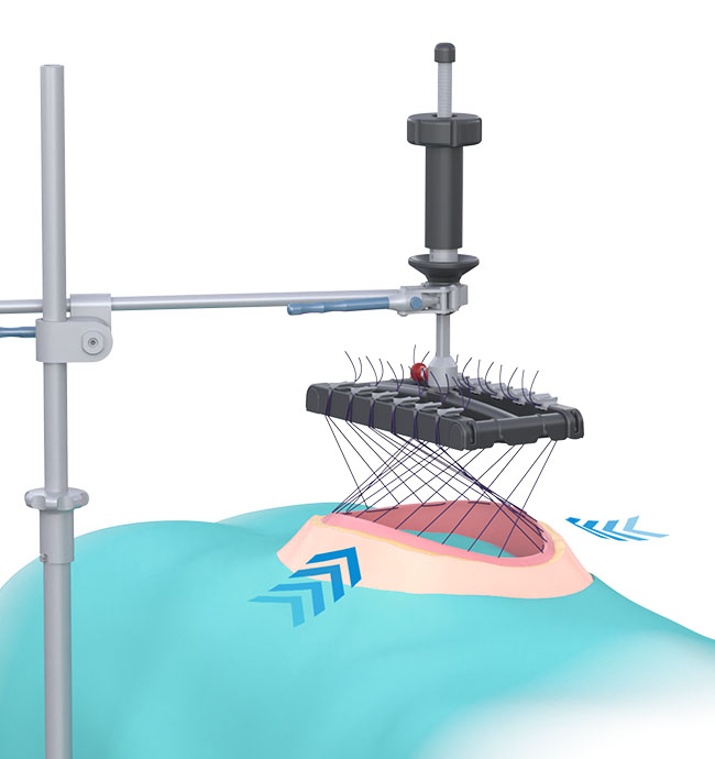 Close hernias gently