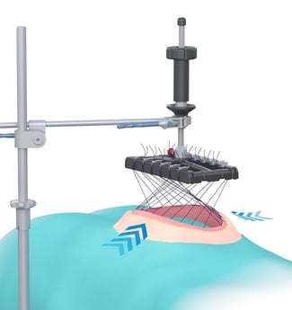 Close hernias gently